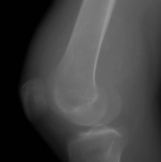 Telangiectatic Osteosarcoma Pathology Orthobullets
